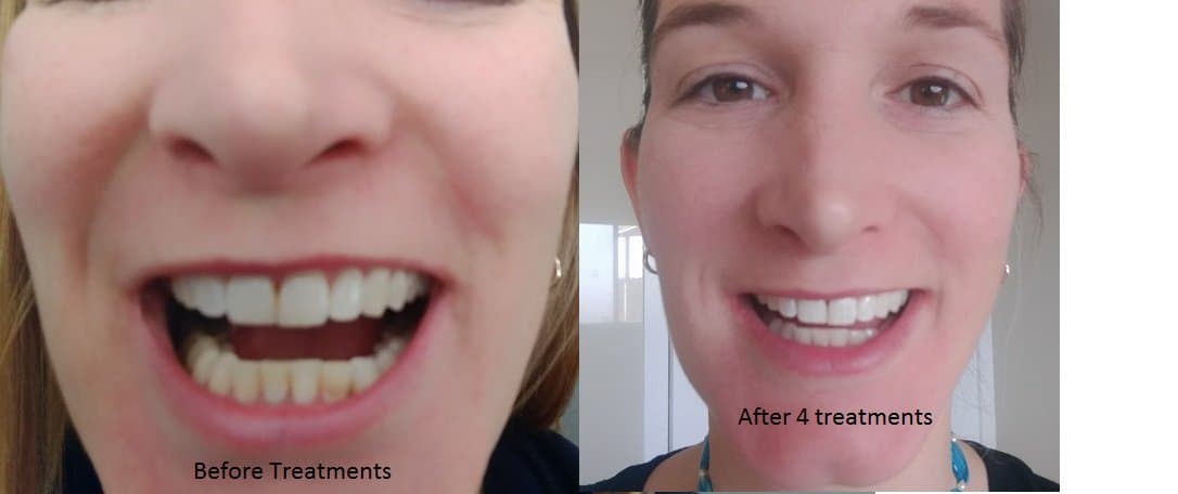 Gogo Smile Complete Teeth Whitening Kit